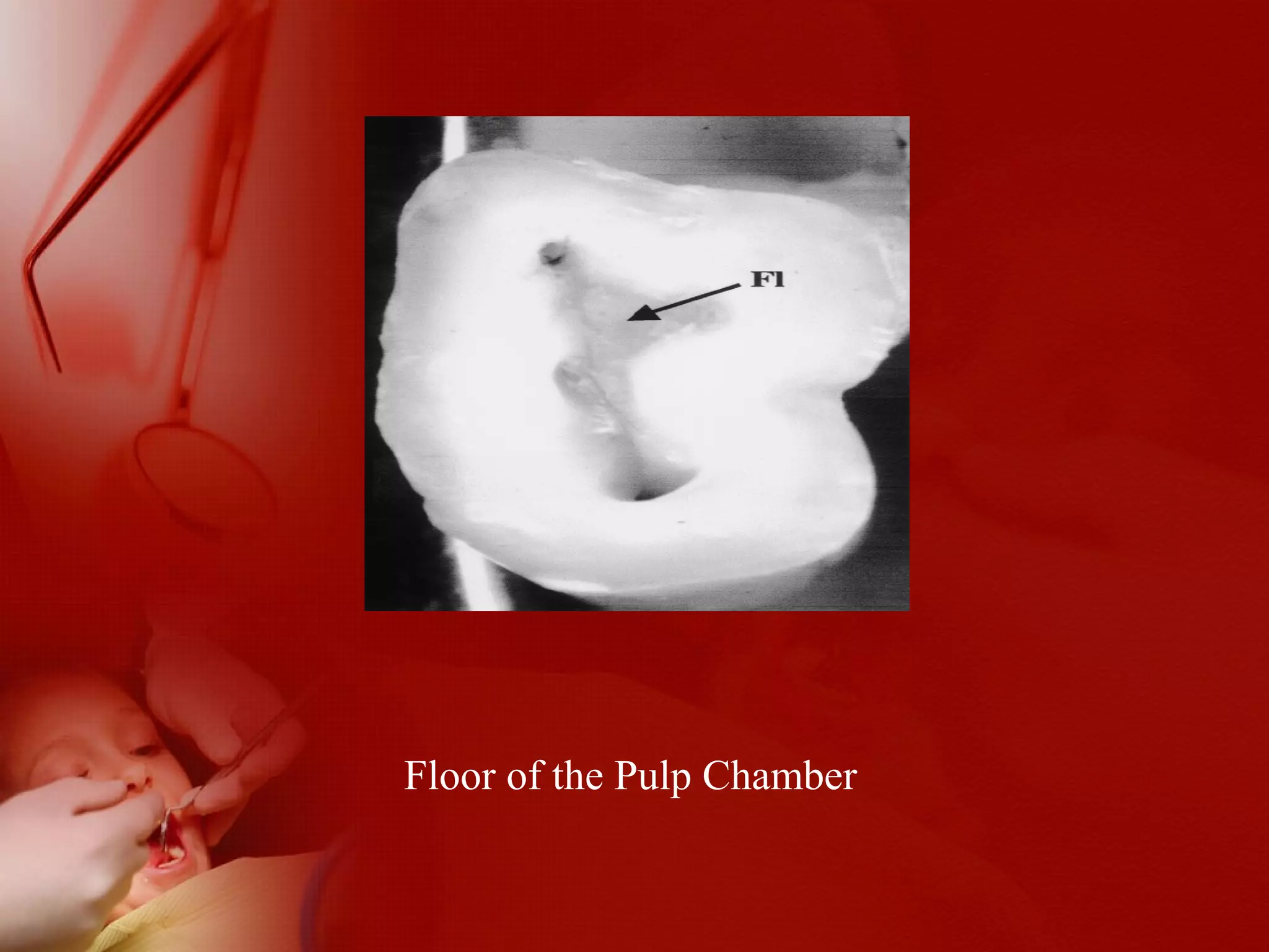 Locating root canal orifice in molar RCT | PPT