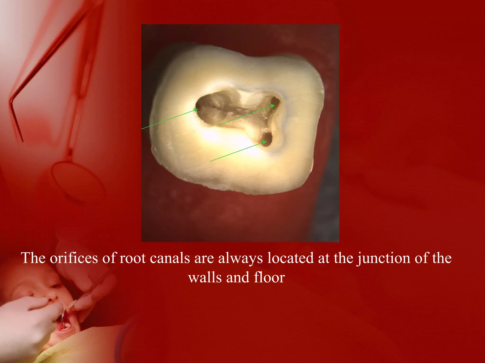 Locating root canal orifice in molar RCT | PPT