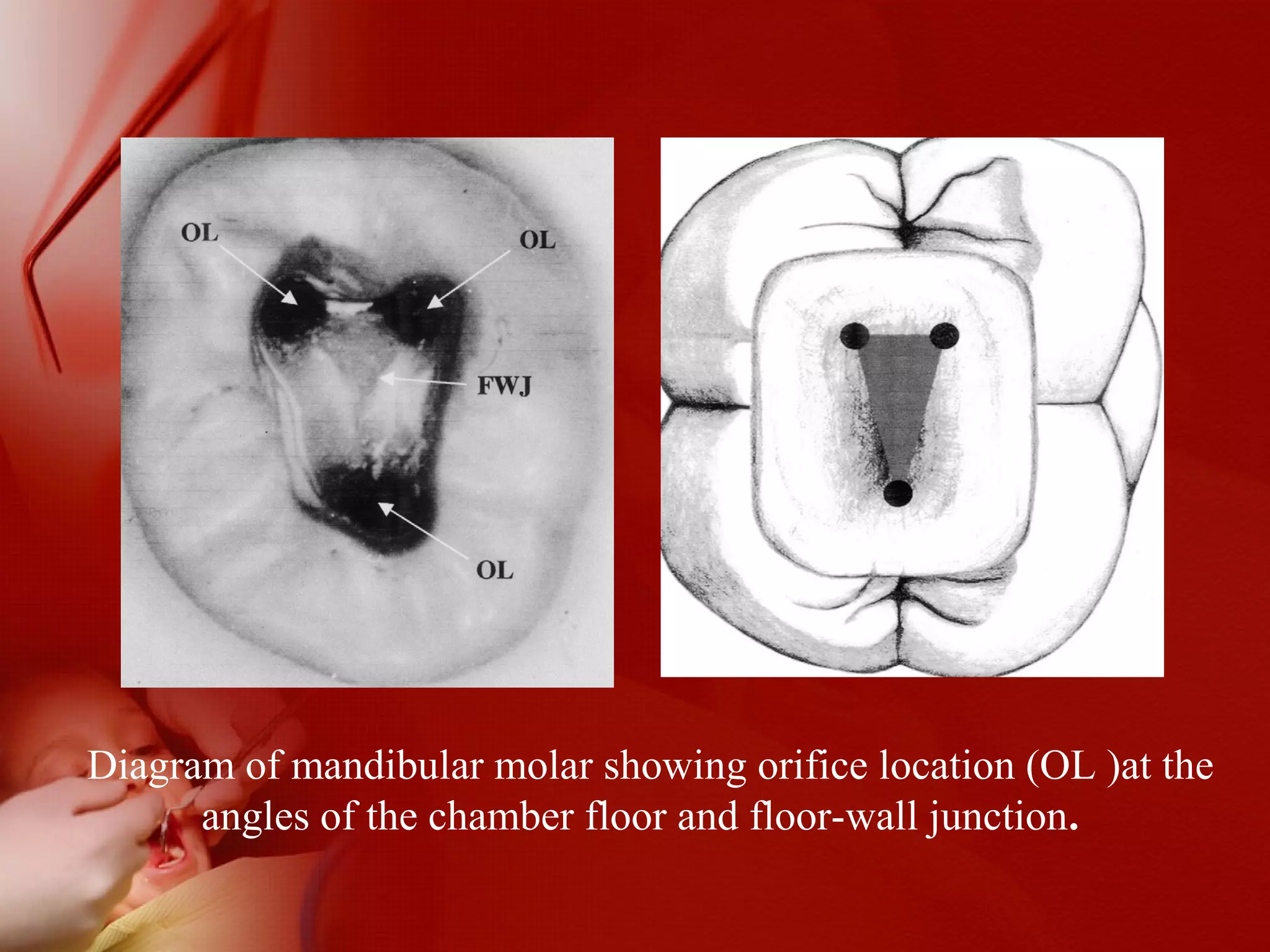 Locating root canal orifice in molar RCT | PPT