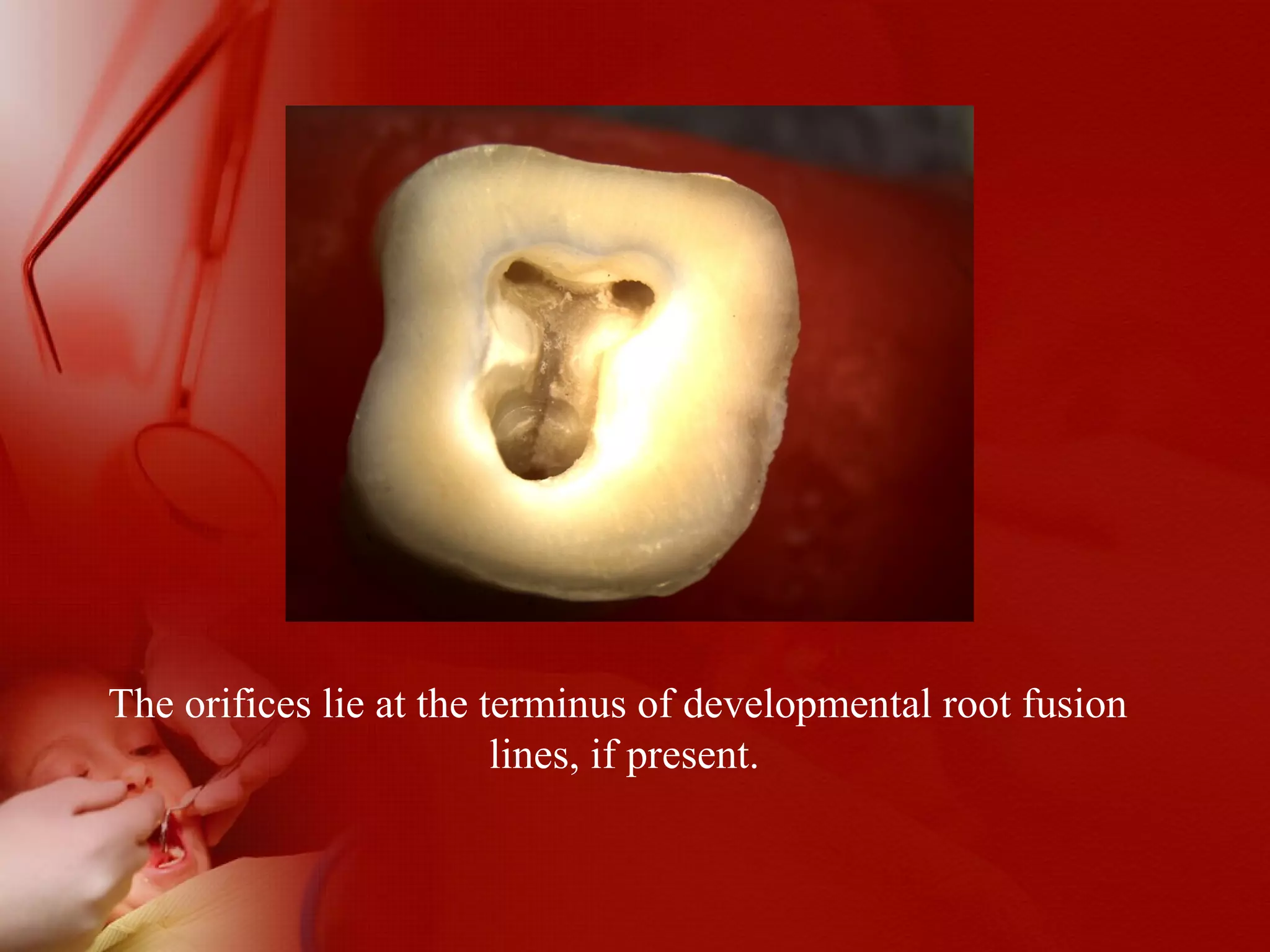 Locating root canal orifice in molar RCT | PPT