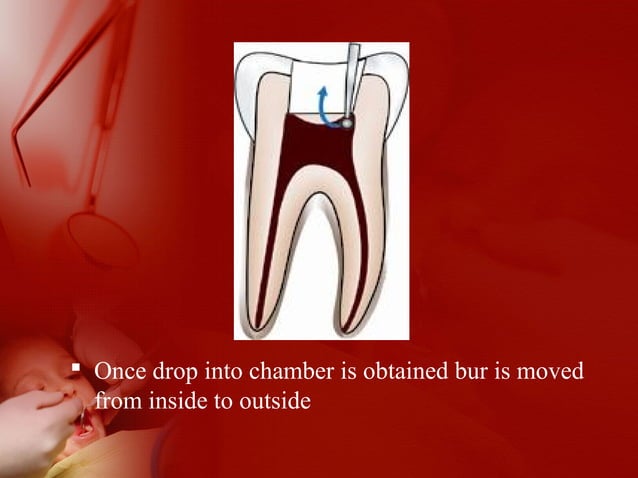 Locating root canal orifice in molar RCT | PPT
