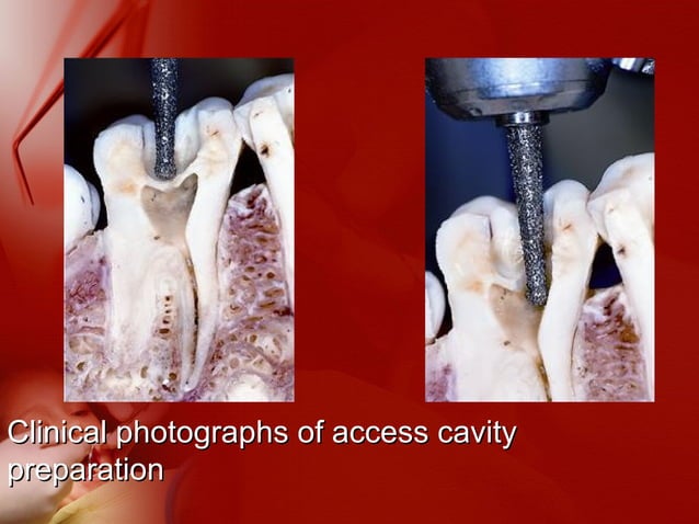 Locating root canal orifice in molar RCT | PPT