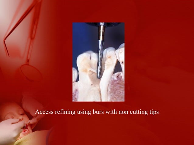 Locating root canal orifice in molar RCT | PPT