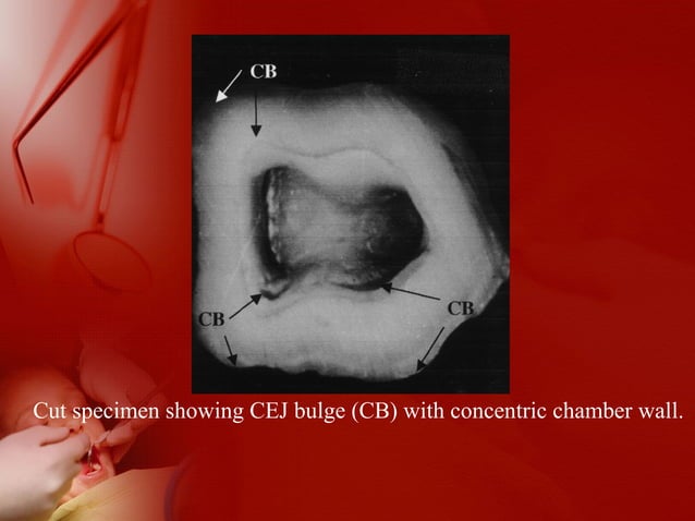 Locating root canal orifice in molar RCT | PPT