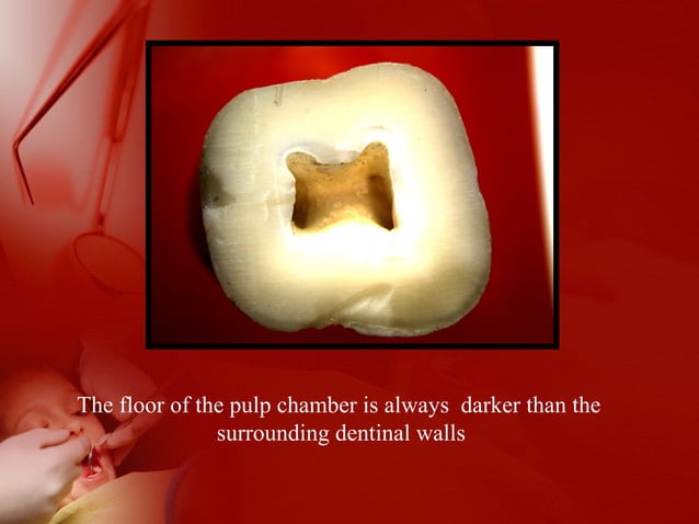 Locating root canal orifice in molar RCT | PPT