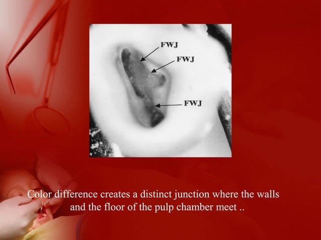 Locating Root Canal Orifice In Molar Rct Ppt