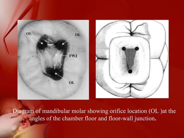 Locating root canal orifice in molar RCT | PPT