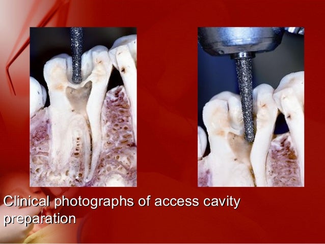 Locating Root Canal Orifice In Molar Rct