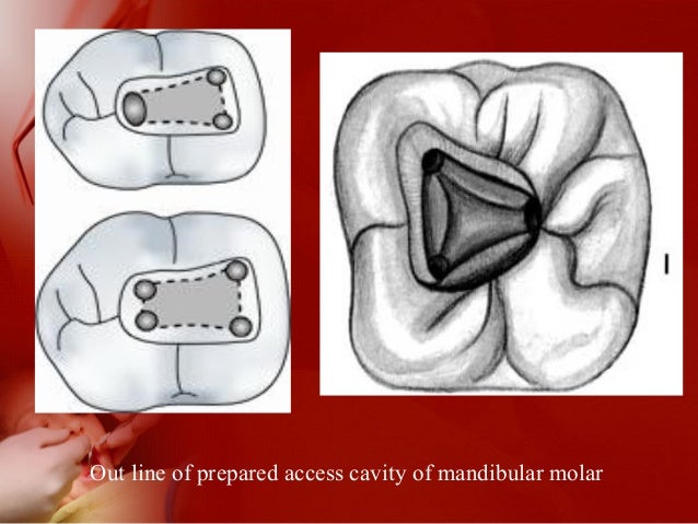 Locating Root Canal Orifice In Molar Rct