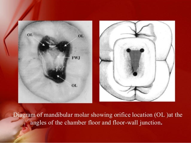Locating Root Canal Orifice In Molar Rct