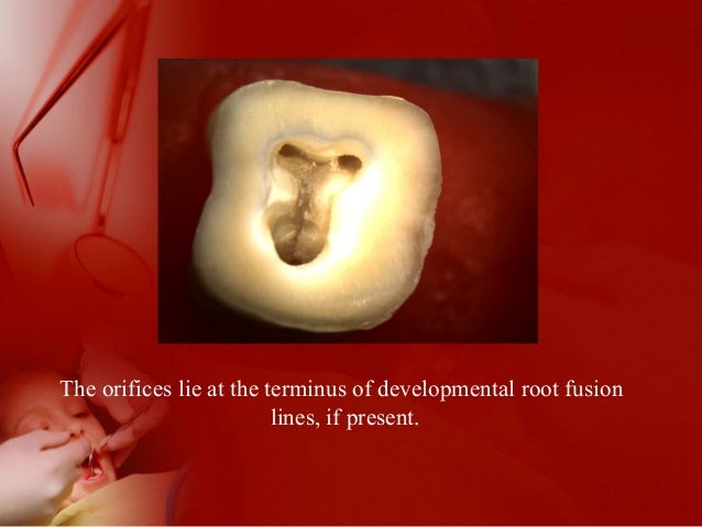 Locating Root Canal Orifice In Molar Rct
