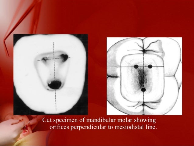 Locating Root Canal Orifice In Molar Rct