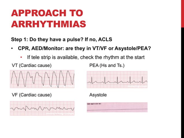 Locke arrhythmia | PPTX