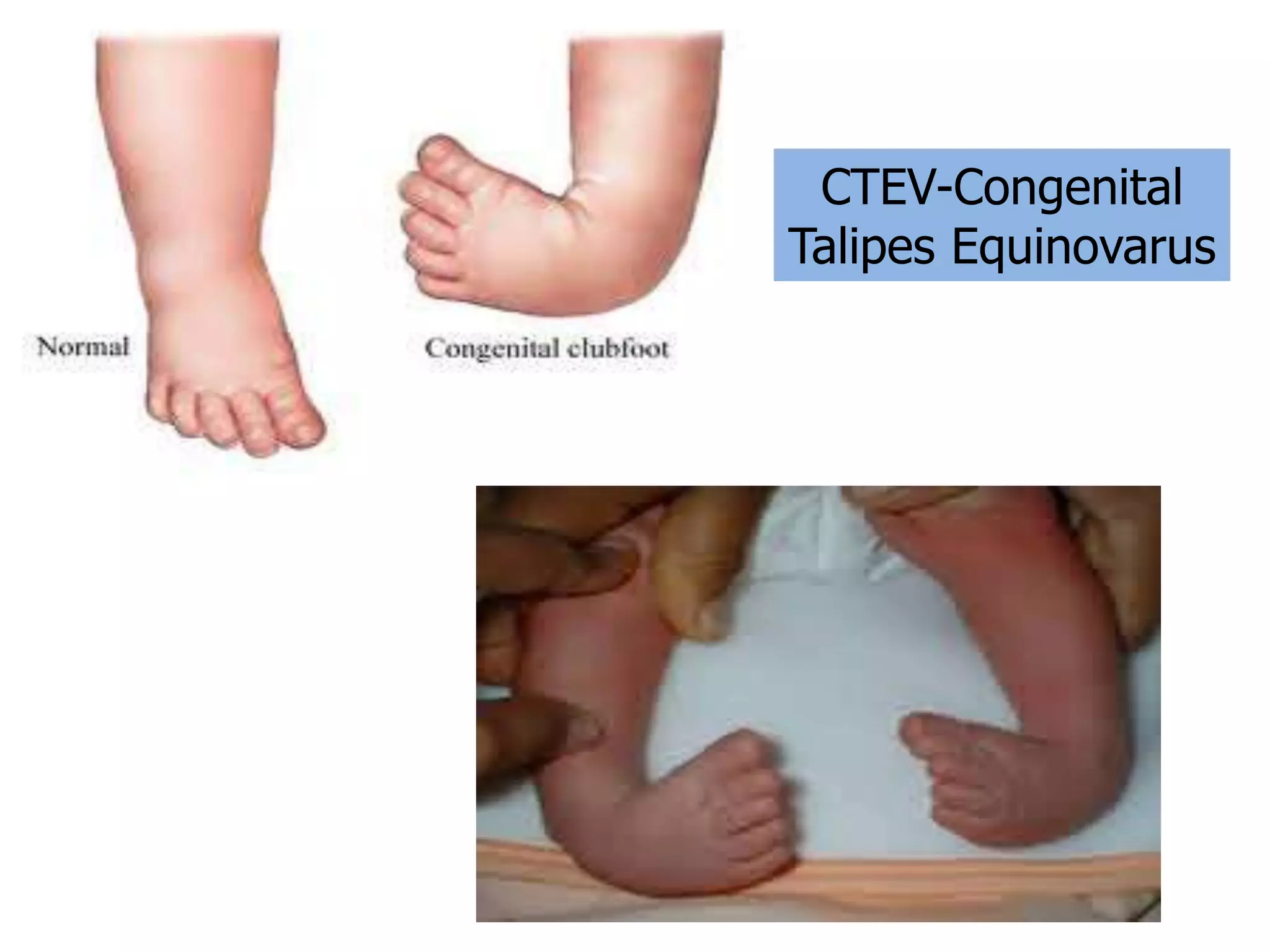 Locomotor disabilities | PPT