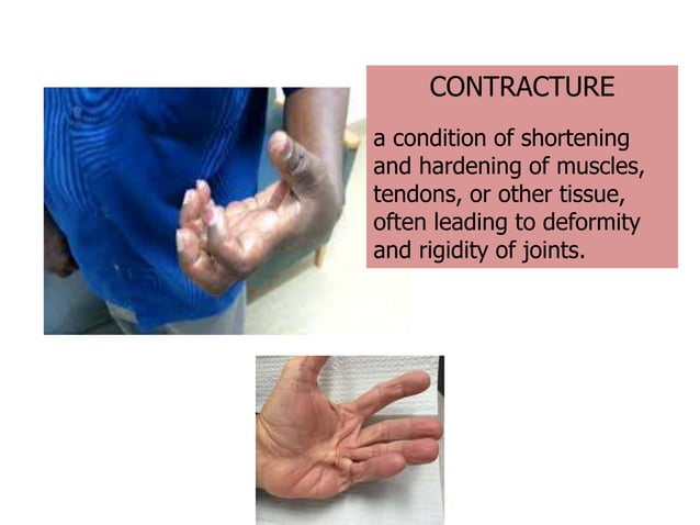 Locomotor disabilities | PPT | Foot Health | Diseases and Conditions