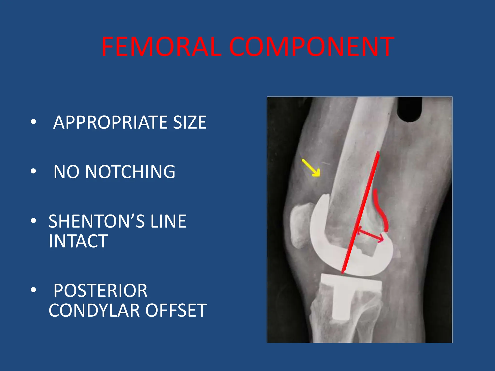 How to Interpret Postoperative X- ray after Total knee arthroplasty.pptx