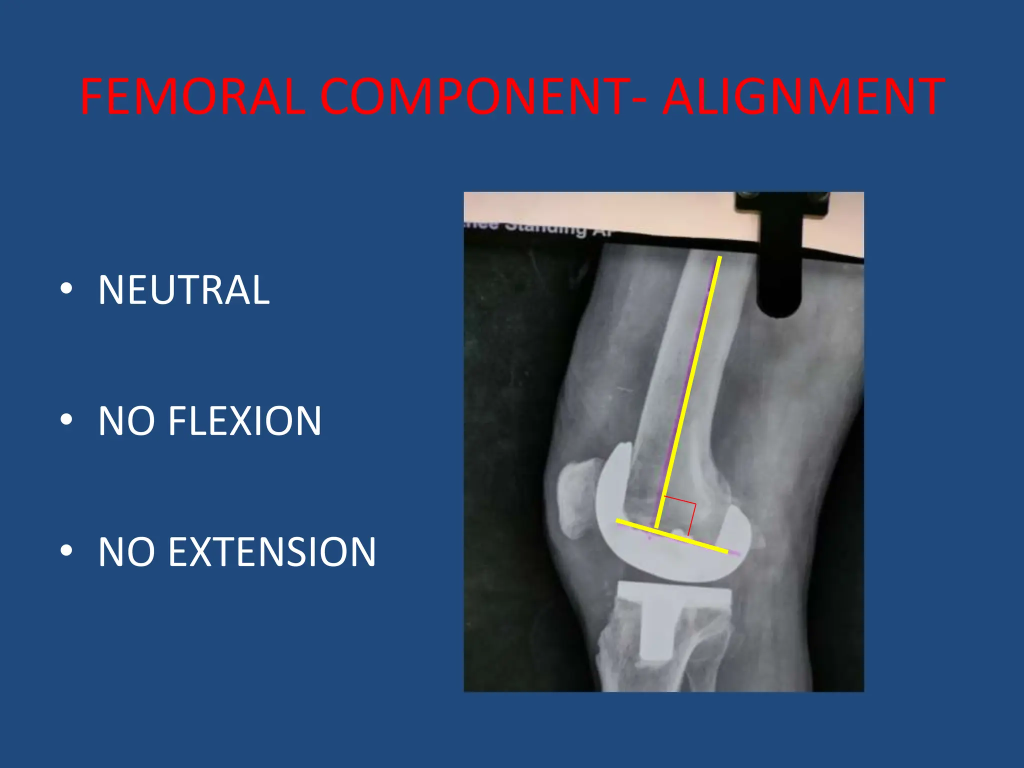 How to Interpret Postoperative X- ray after Total knee arthroplasty.pptx