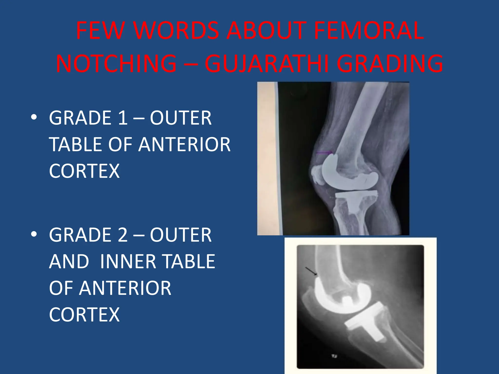How to Interpret Postoperative X- ray after Total knee arthroplasty.pptx