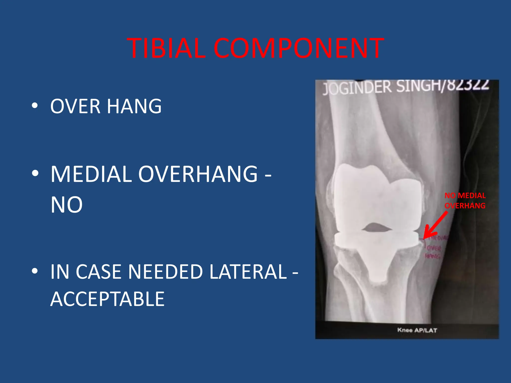How to Interpret Postoperative X- ray after Total knee arthroplasty.pptx