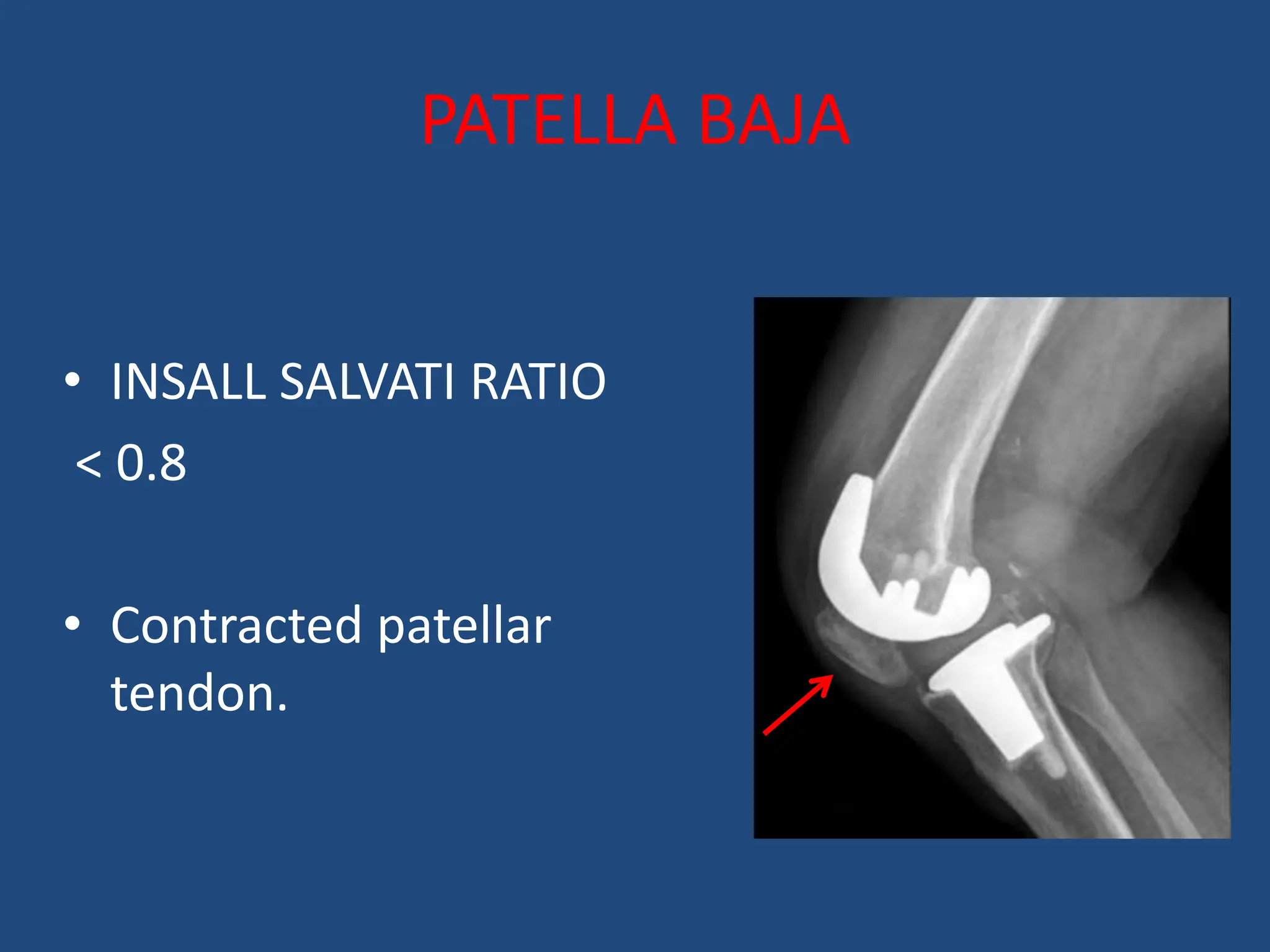How to Interpret Postoperative X- ray after Total knee arthroplasty.pptx
