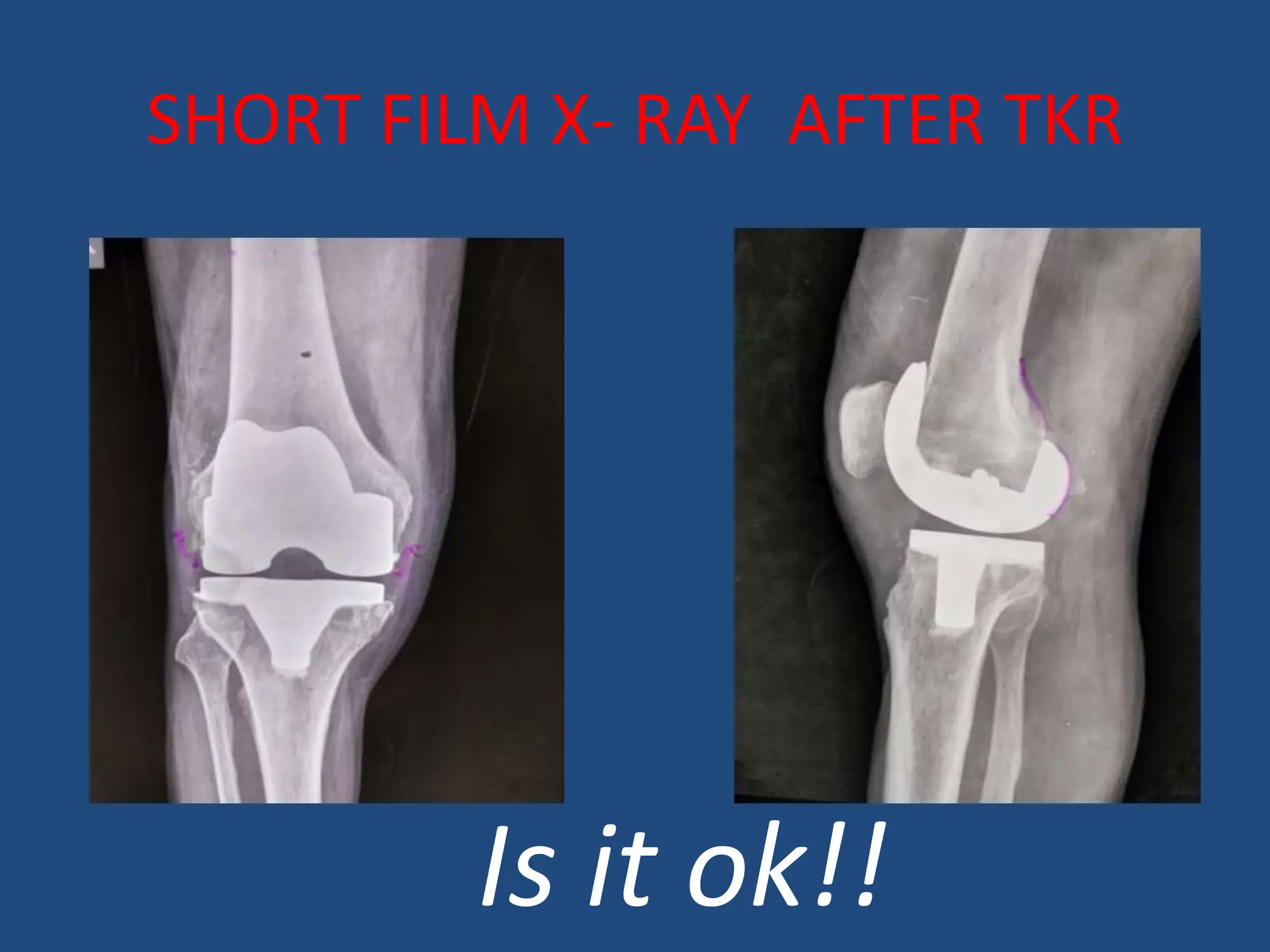 How to Interpret Postoperative X- ray after Total knee arthroplasty.pptx
