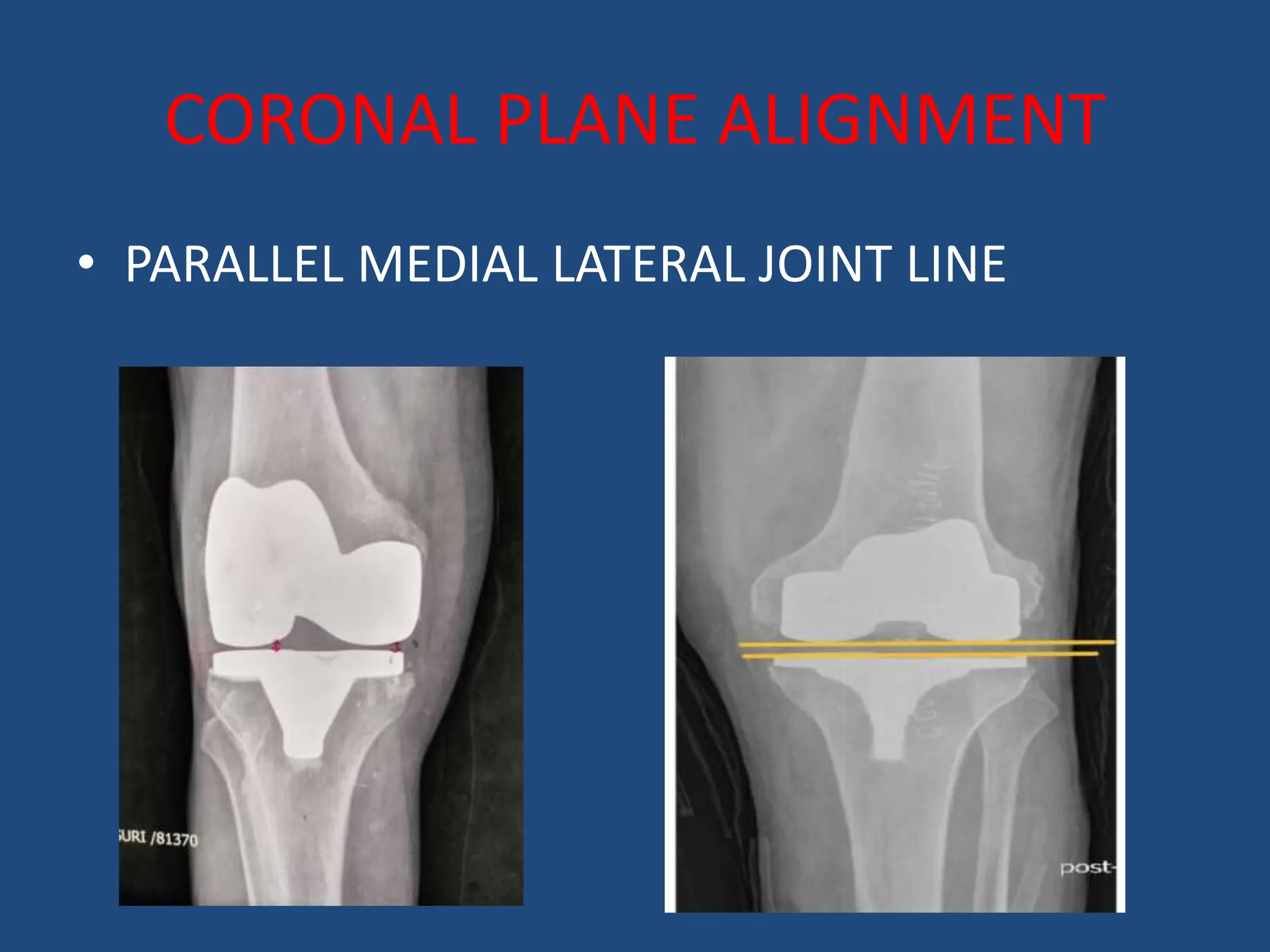 How to Interpret Postoperative X- ray after Total knee arthroplasty.pptx