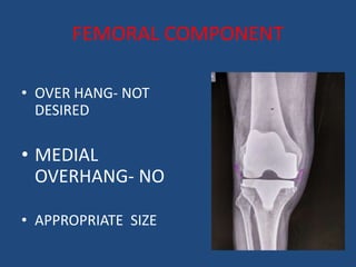 How to Interpret Postoperative X- ray after Total knee arthroplasty.pptx