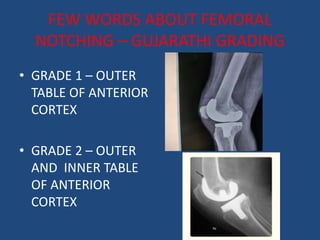 How to Interpret Postoperative X- ray after Total knee arthroplasty.pptx