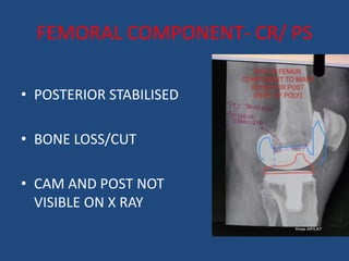 How to Interpret Postoperative X- ray after Total knee arthroplasty.pptx