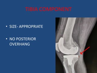 How to Interpret Postoperative X- ray after Total knee arthroplasty.pptx
