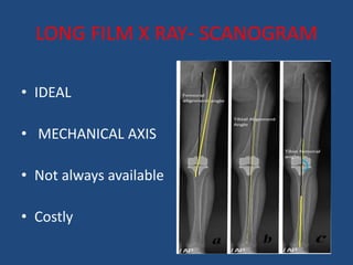 How to Interpret Postoperative X- ray after Total knee arthroplasty.pptx