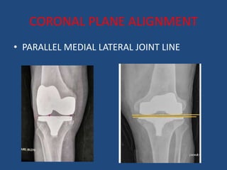 How to Interpret Postoperative X- ray after Total knee arthroplasty.pptx