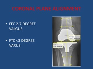 How to Interpret Postoperative X- ray after Total knee arthroplasty.pptx