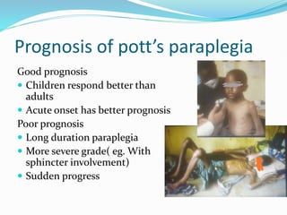 Tuberculosis Spine complication...POTT’S PARAPLEGIA.pptx | Physical ...
