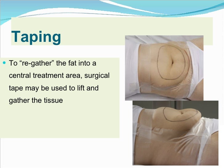 Flank Area (small): Position the