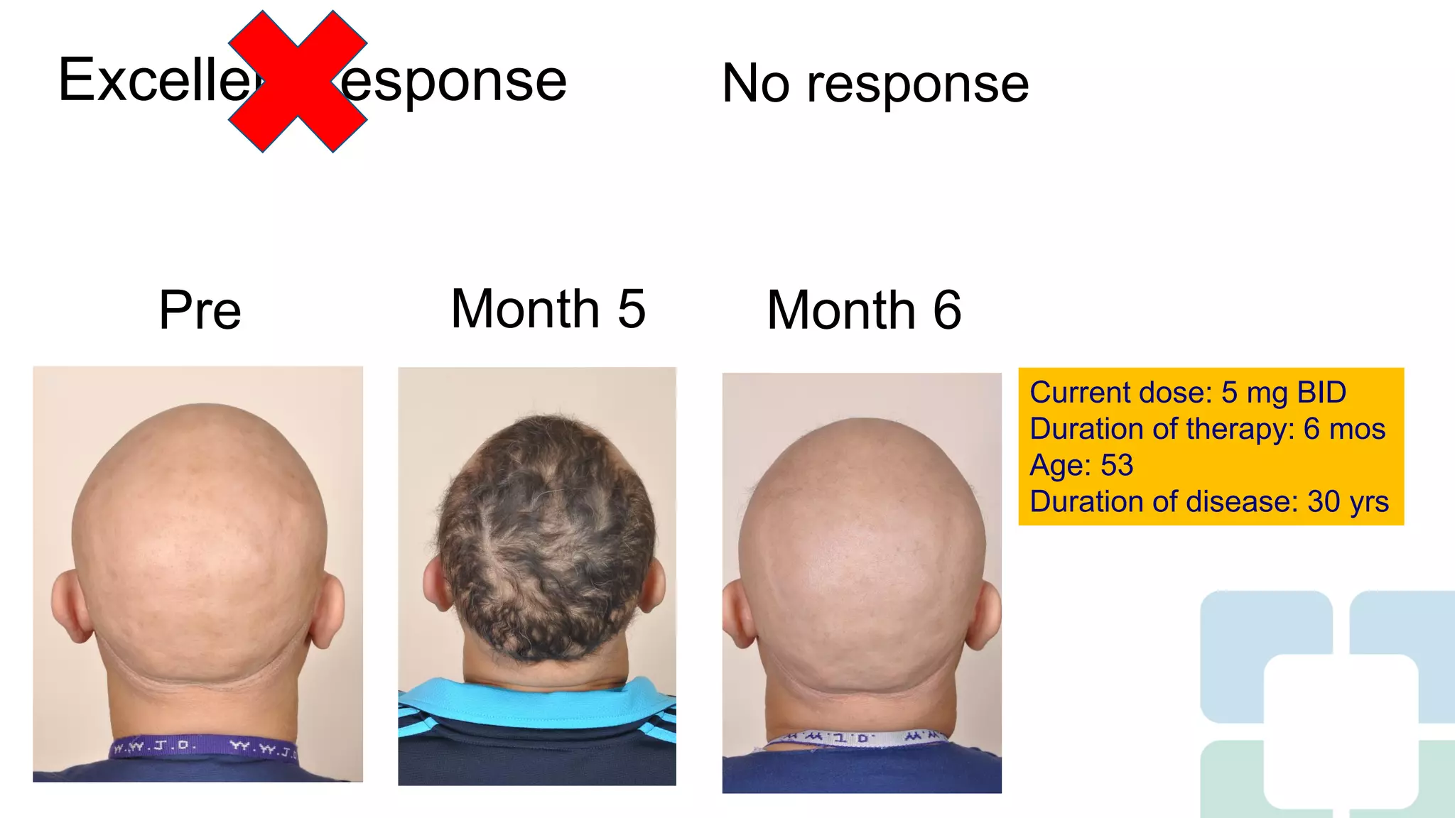 Long Term Treatment for Severe Alopecia Areata with Oral Tofacitinib ...
