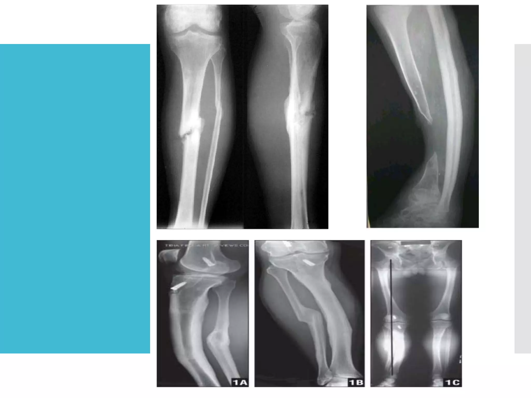 Long bone fracture complication | PPTX
