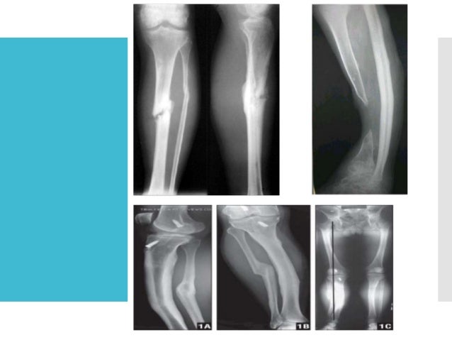 Long bone fracture complication