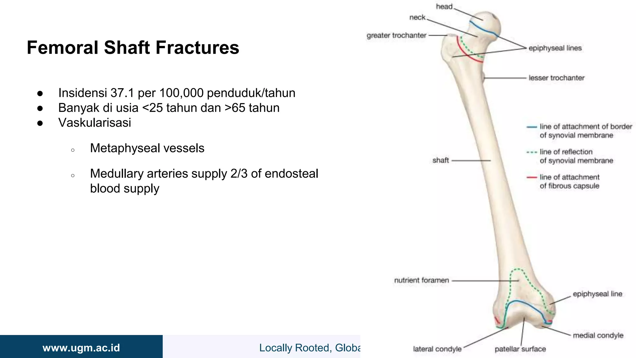 Long Bone Fractures - DEA (1).pptx