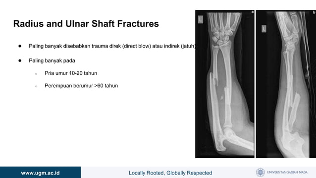Long Bone Fractures - DEA (1).pptx