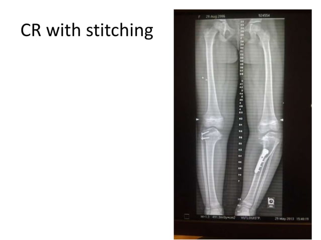 Long bone measurement | PPT | Free Download