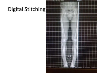 Long bone measurement | PPT