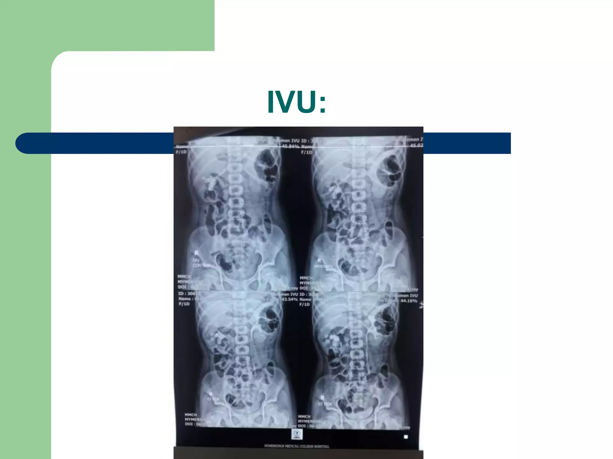 Long case..Renal stone.ppt