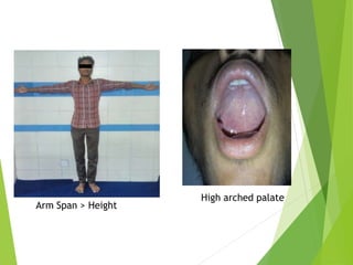 Long case marfan syndrome | PPTX