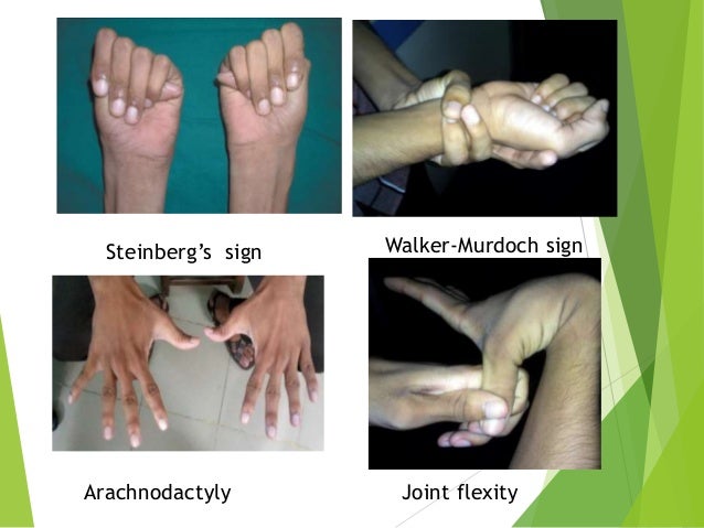 Long case marfan syndrome