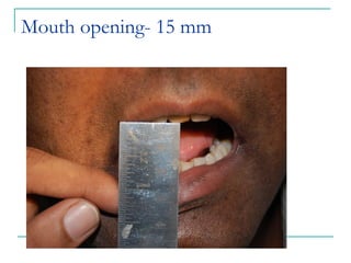 Long case osmf | PPT