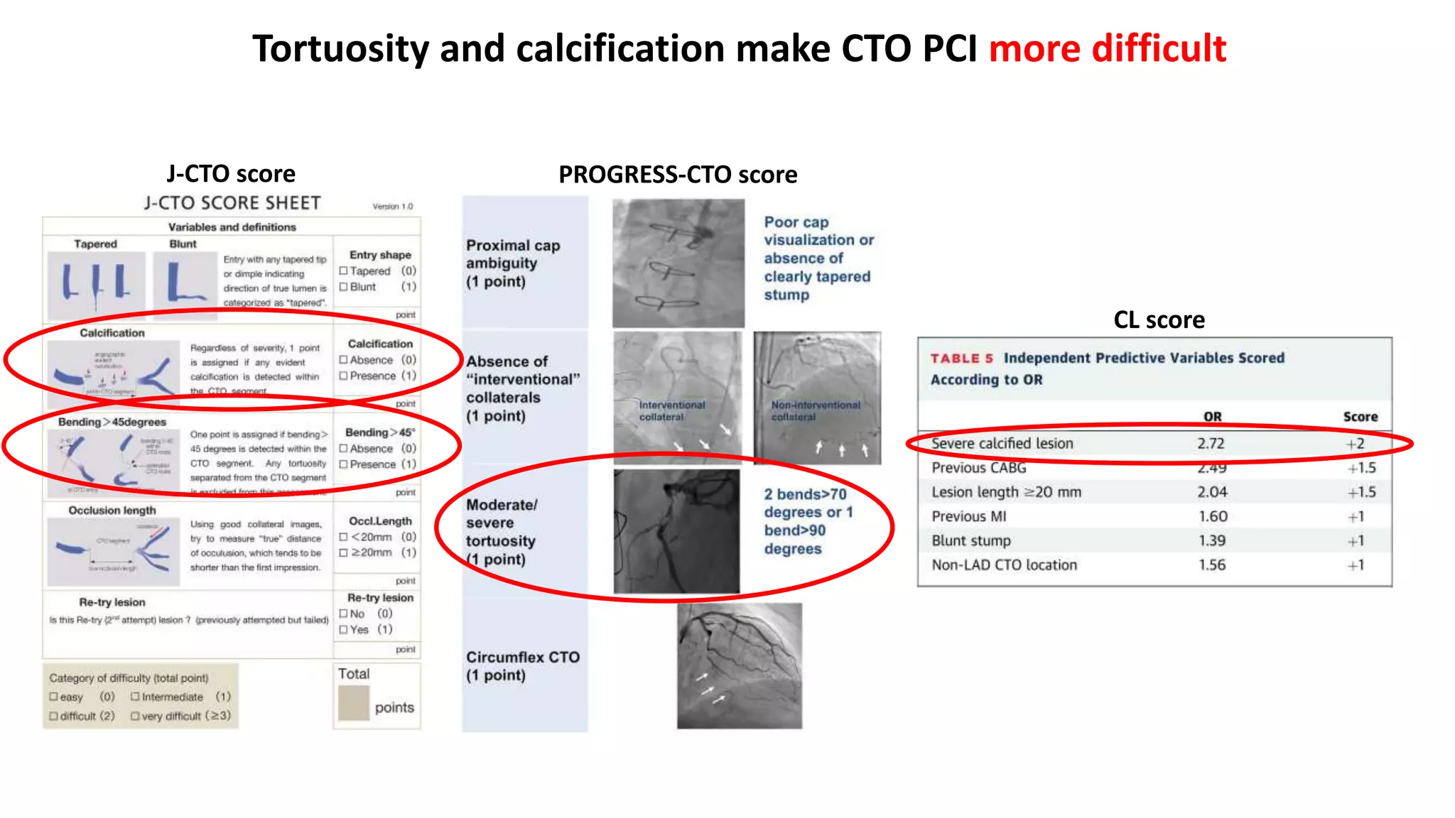 Long CTO with tortuosity, calcifications: How to progress inside the ...