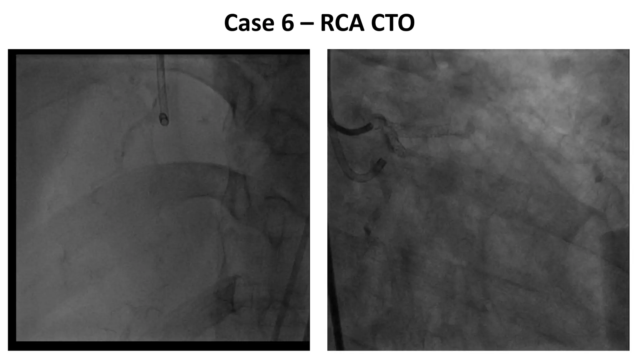Long CTO with tortuosity, calcifications: How to progress inside the ...