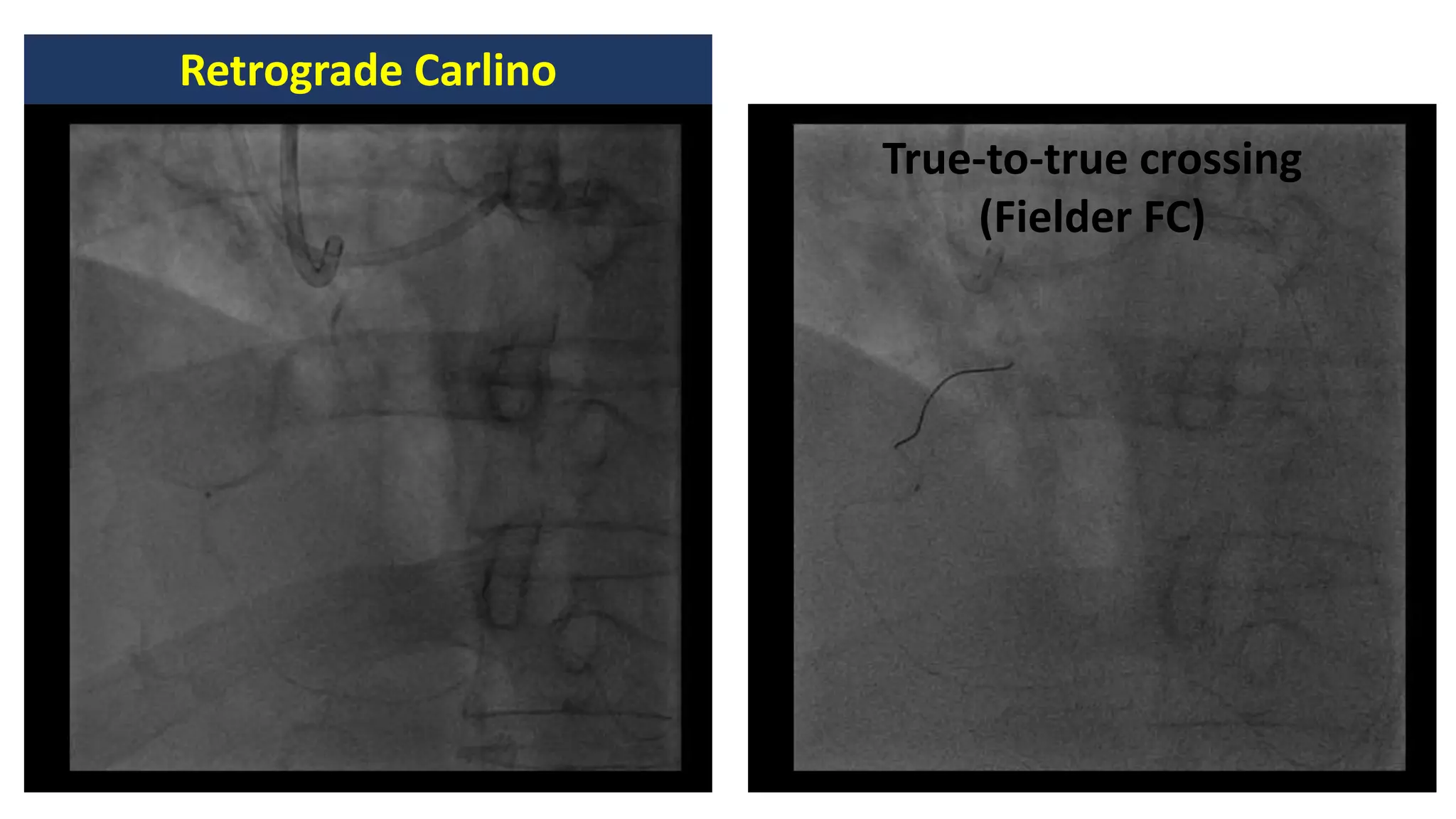 Long CTO with tortuosity, calcifications: How to progress inside the ...