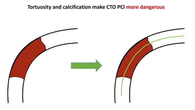 Long CTO with tortuosity, calcifications: How to progress inside the ...